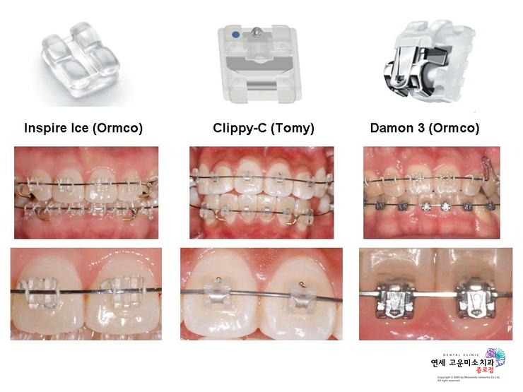 심미적 자가결찰 세라믹 장치인 클리피씨(Clippy-C) 브라켓 : 네이버 블로그