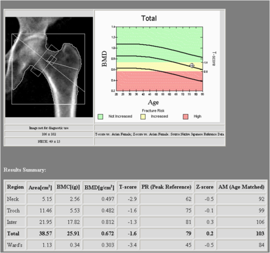 BMD(골밀도검사 Bone mineral densitometry)결과의 해석 : 네이버 블로그