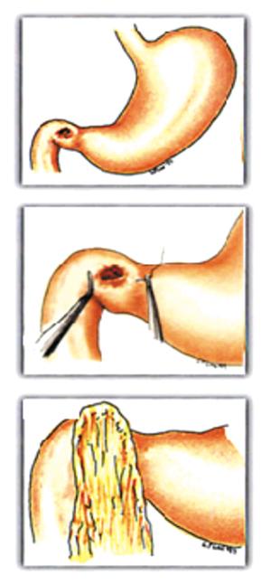 Graham patch : 네이버 블로그