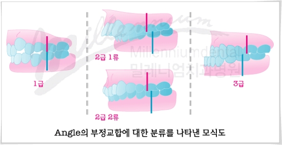 치아교정 "Angle의 1급 2급 3급 부정교합 분류" : 밀레니엄치과 : 네이버 블로그
