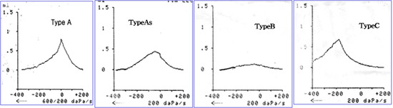 Tympanogram : 네이버 블로그
