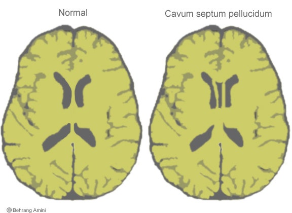 뇌실사이중격강 (cavum septum pellucidium) : 네이버 블로그