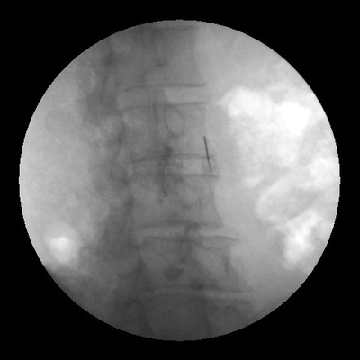 Psoas Compartment Block : 네이버 블로그