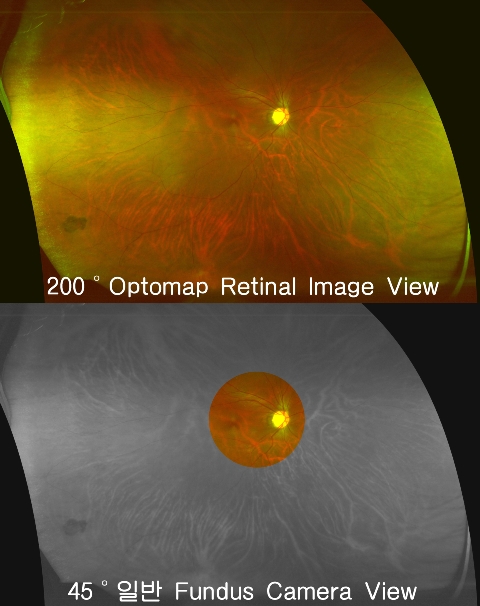 optos optomap - 옵토스 옵토맵 : 네이버 블로그