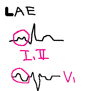 left atrial enlargement (LAE)EKG : 네이버 블로그