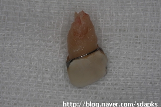 우리아이 유치 앞니의 기성금관 - open faced SS crown (용인치과,동백치과) : 네이버 블로그