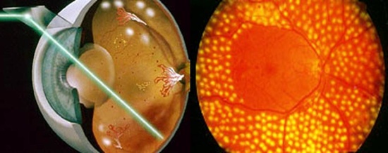 당뇨망막병증의 레이져 치료(Laser Treatment of diabetic retinopathy) : 네이버 블로그