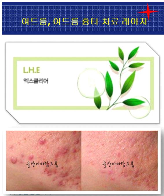 울산피부과 광선에너지lhe를 활용한 울산여드름 치료방법 엑스클리어 아크네 레이저 네이버 블로그