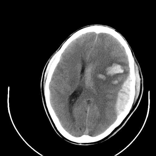 SAH.ICH, Lt.EDH, Lt. : 네이버 블로그