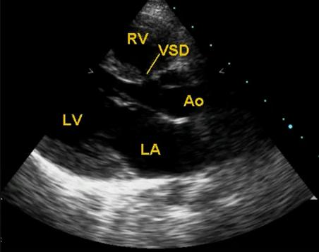 선천성 심장기형 - Ventricular septal defect : 네이버 블로그