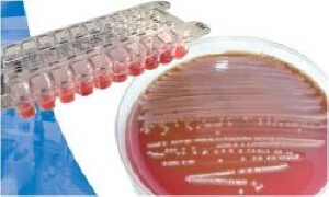 사슬알균 감염 Antistreptolysin O antibody (ASO) : 네이버 블로그