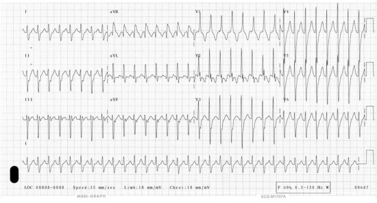 Verapamil-sensitive ventricular tachycardia(ILVT, Belhassen VT)에 관하여 ...