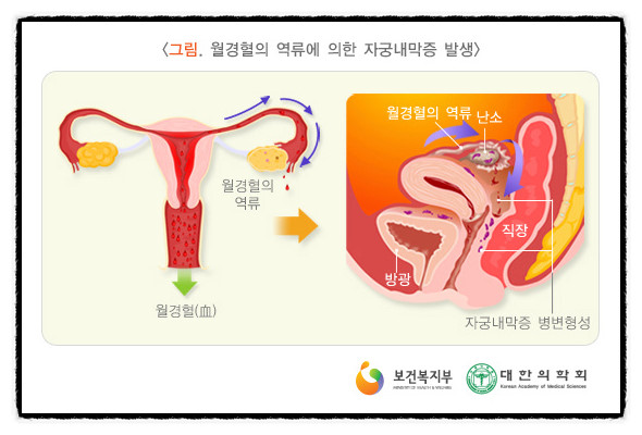 생리혈이 원활하게 배출되지 못하면 그 피가 역류할 수도 있다고 대전 생리통 한의원 진통제 자궁단 월경혈 역류