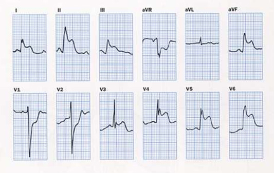 후하벽경색(posterolateral wall infarction)의 심전도(EKG) : 앞서 본 급성심근염의 심전도와의 비교 ...