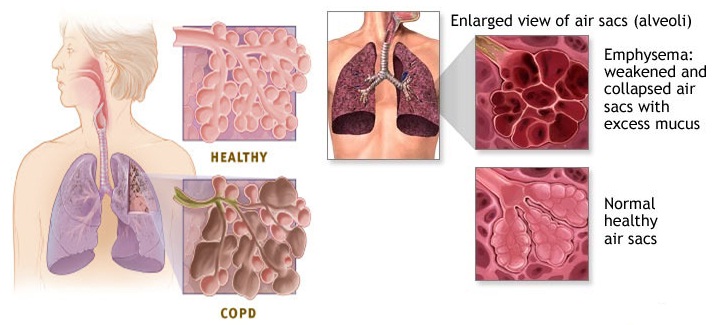 만성 폐쇄성 폐질환(Chronic Obstructive Pulmonary Disease; COPD) : 네이버 블로그