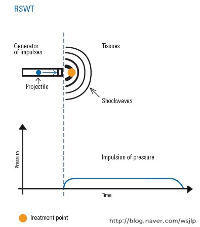 RSWT (방사형 체외충격파 치료기) : 네이버 블로그