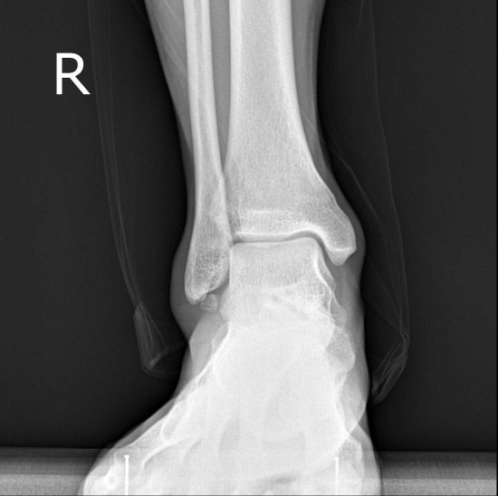 비골하 부골증(Os subfibulare), 외측 복사뼈 견열 골절, 발목 뼛조각 : 네이버 블로그