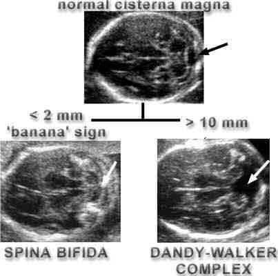 mega cisterna magna 에 대해서 : 네이버 블로그
