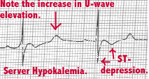 EKG : 네이버 블로그