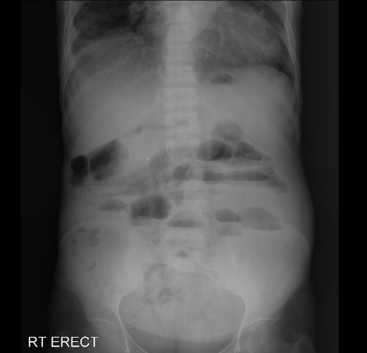 Ileus : 네이버 블로그