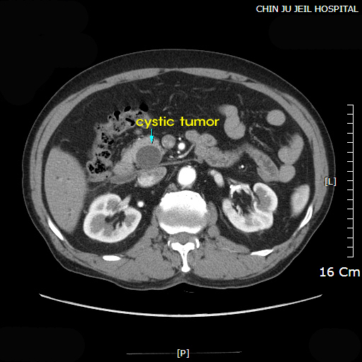 밤을 새워 해낸 Laparoscopic Whipple's operation : 네이버 블로그