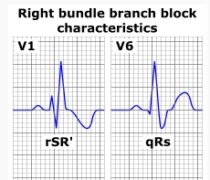 RBBB/ RBBB with MI/의학 블로그, 세균맨 : 네이버 블로그
