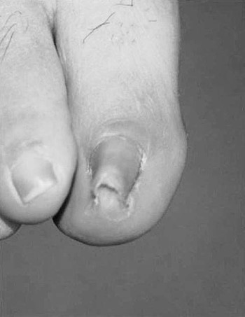 [내향성발톱(내성발톱)] Matrixplasty for the Treatment of Severe Incurved Toenail ...