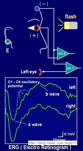 시각유발전위 - ERG, Electro Retinogram, 망막전위도 : 네이버 블로그