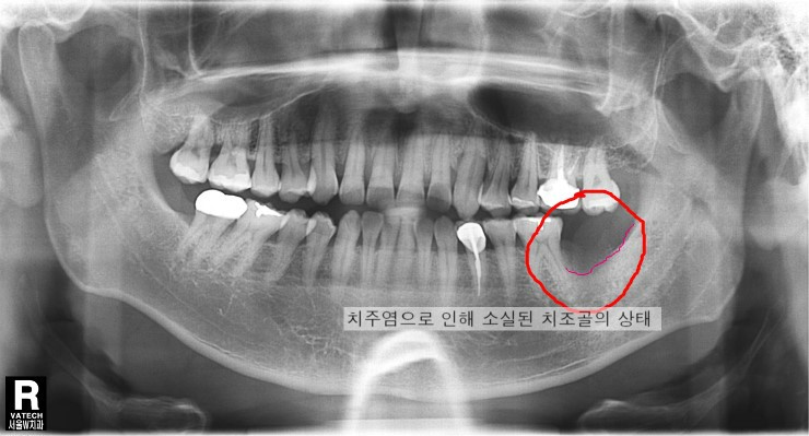 임플란트 치조골이식술 인공뼈이식수술 잠실치과 잠실w치과 잠실서울w치과 신천역치과 네이버 블로그