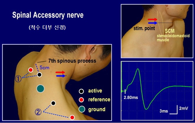 척수더부신경 운동전도검사 Spinal Accessory nerve - 체간 검사 (신경전도검사) : 네이버 블로그