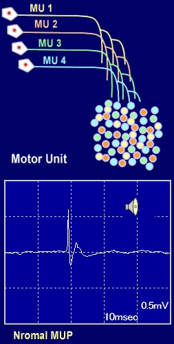 근전도 EMG Electromyograph - Needle EMG (Step 3. MUP - Motor unit ...