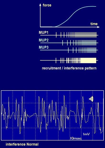 근전도 EMG Electromyograph - Needle EMG (Step 4. Recruitment ...