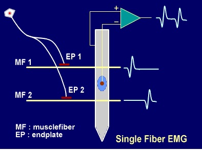 근전도 EMG Electromyograph - Single Fiber EMG : 네이버 블로그