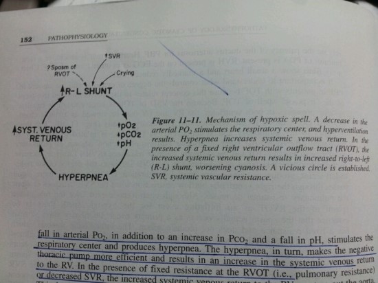 Fallot 4징에서 무산소 발작(anoxic spell)이 발생되는 기전을 설명하고, 치료방법을 설명한다.TOF.anoxic ...