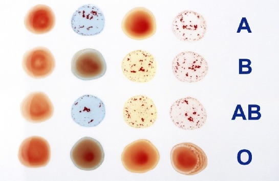 ABO 혈액형 검사(ABO Typing) : 네이버 블로그