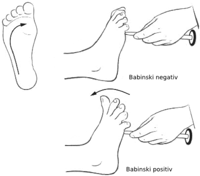 뇌졸중(Stroke) 응급처치(바빈스키반사,FAST,섬망) : 네이버 블로그