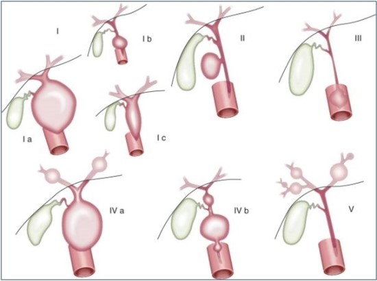 Choledochol cyst classification : Todani : 네이버 블로그