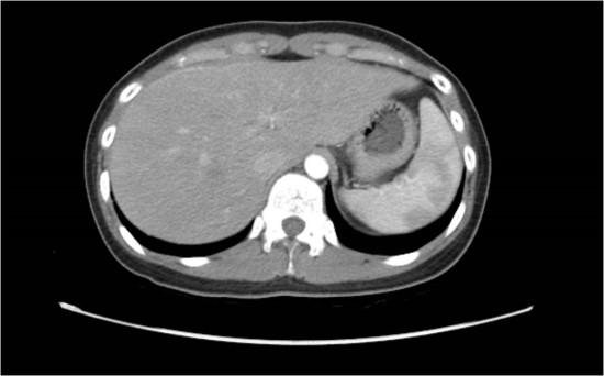 Perihepatitis(Fitz-Hugh-Curtis syndrome) : 네이버 블로그