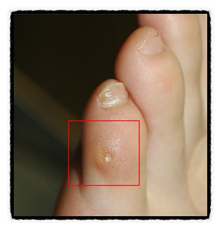 티눈/굳은살 (Corn/Clavus) : 네이버 블로그