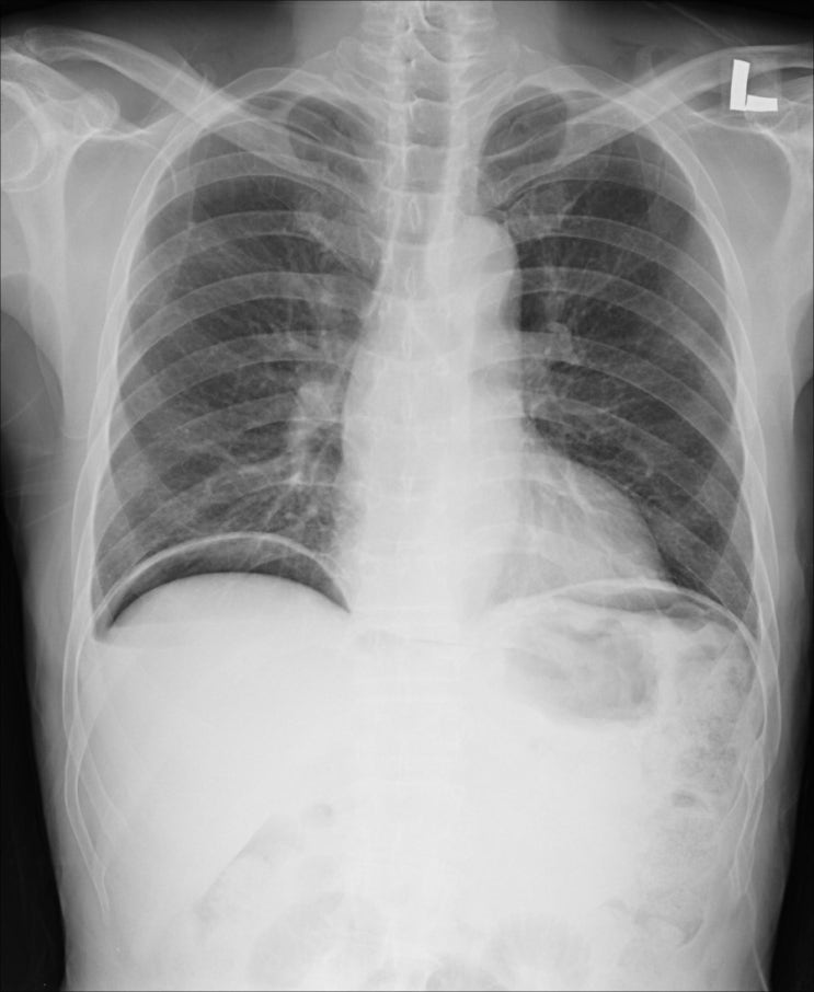RLL necrotizing pneumonia : 네이버 블로그