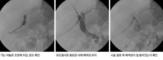 PTBD(percutaneous transhepatic biliary drainage) 경피적 경간 담즙 배액술 : 네이버 블로그