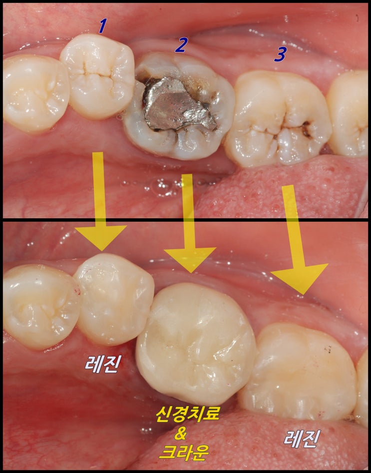 아말감 재치료 방법어금니 충치치료 방법 수유기간 충치치료 충치치료 언제할 것인가 Of 드림팩토리치과 네이버 블로그