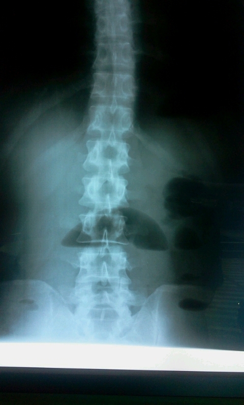 배가 갑자기 많이 아프셔서 오신 젊은 남자 환자분입니다. 뭔가 일반적인 복통은 아닌 것 같아서 복부 X-RAY 촬영을 해봤습니다 ...