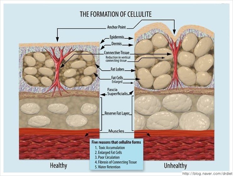 셀룰라이트에 대해 자세히 알아볼까요? : 네이버 블로그