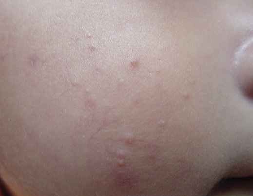 신생아여드름과 영아여드름(Acne neonatorum & Acne infantum) : 네이버 블로그