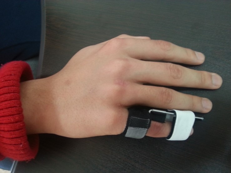 손가락 측부 인대 손상 /Collateral Ligament Disruption - finger / 3pp Buddy Loops ...