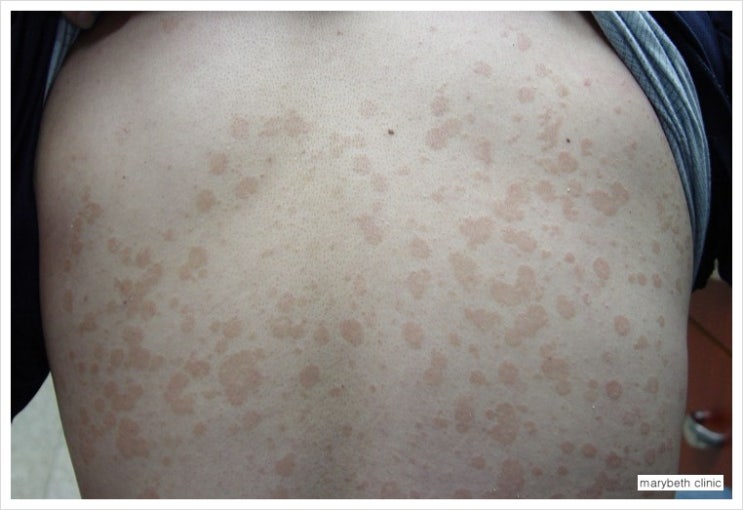 어루러기(Pityriasis versicolor) : 네이버 블로그