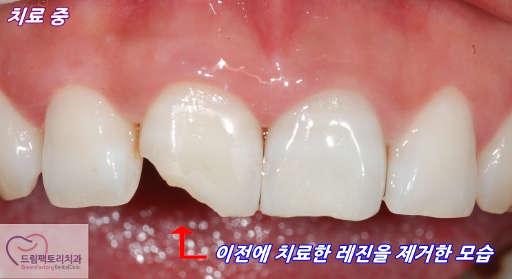 오래된 변색된 앞니 레진 재치료하기 부러진앞니 레진 재치료 레진 변색 By 드림팩토리치과 네이버 블로그