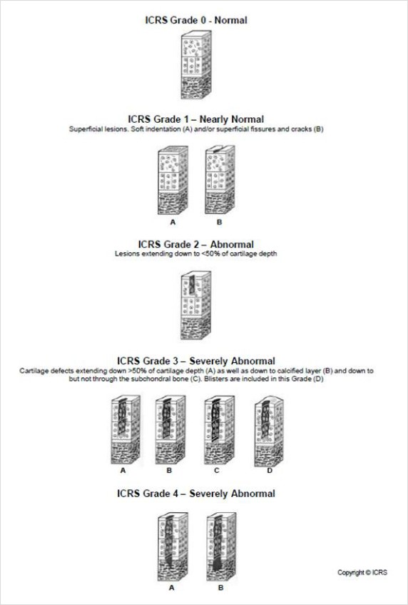 Chondral lesion grading (관절연골손상 분류) : Outerbridge & ICRS : 네이버 블로그