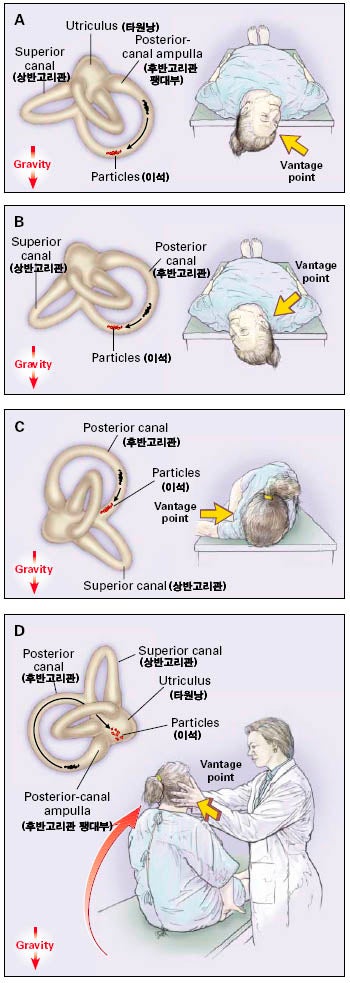 DizzyFix - 양성 돌발성 체위성 현훈증(이석증 BPPV) 자가 치료기입니다 - 재발로 고생하시는분들 참고하시면 좋을 ...